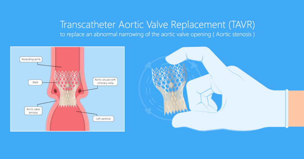 Transcatheter Aortic Valve Replacement (TAVR) - Oklahoma Heart Hospital