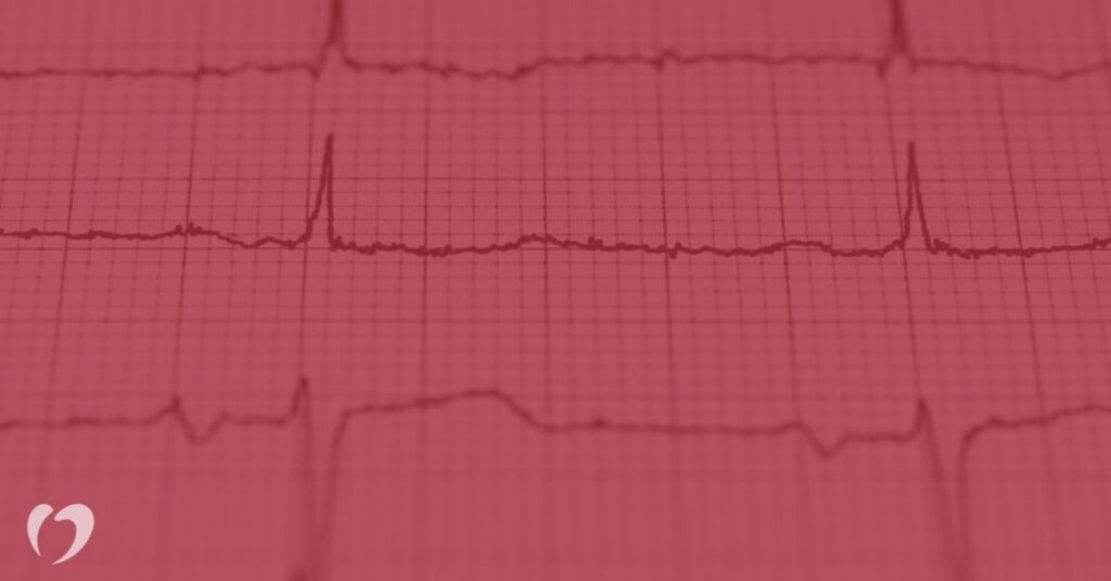 Understanding Implantable Loop Recorders - Oklahoma Heart Hospital
