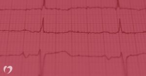 Understanding Implantable Loop Recorders - Oklahoma Heart Hospital