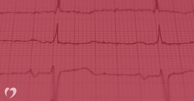 Understanding Implantable Loop Recorders - Oklahoma Heart Hospital