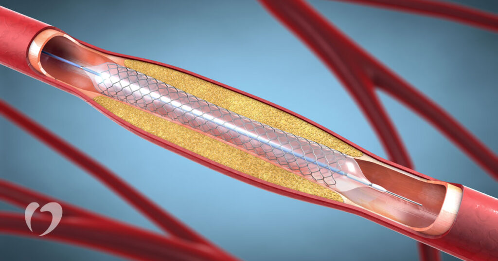 What to Expect During and After Stent Placement - Oklahoma Heart Hospital